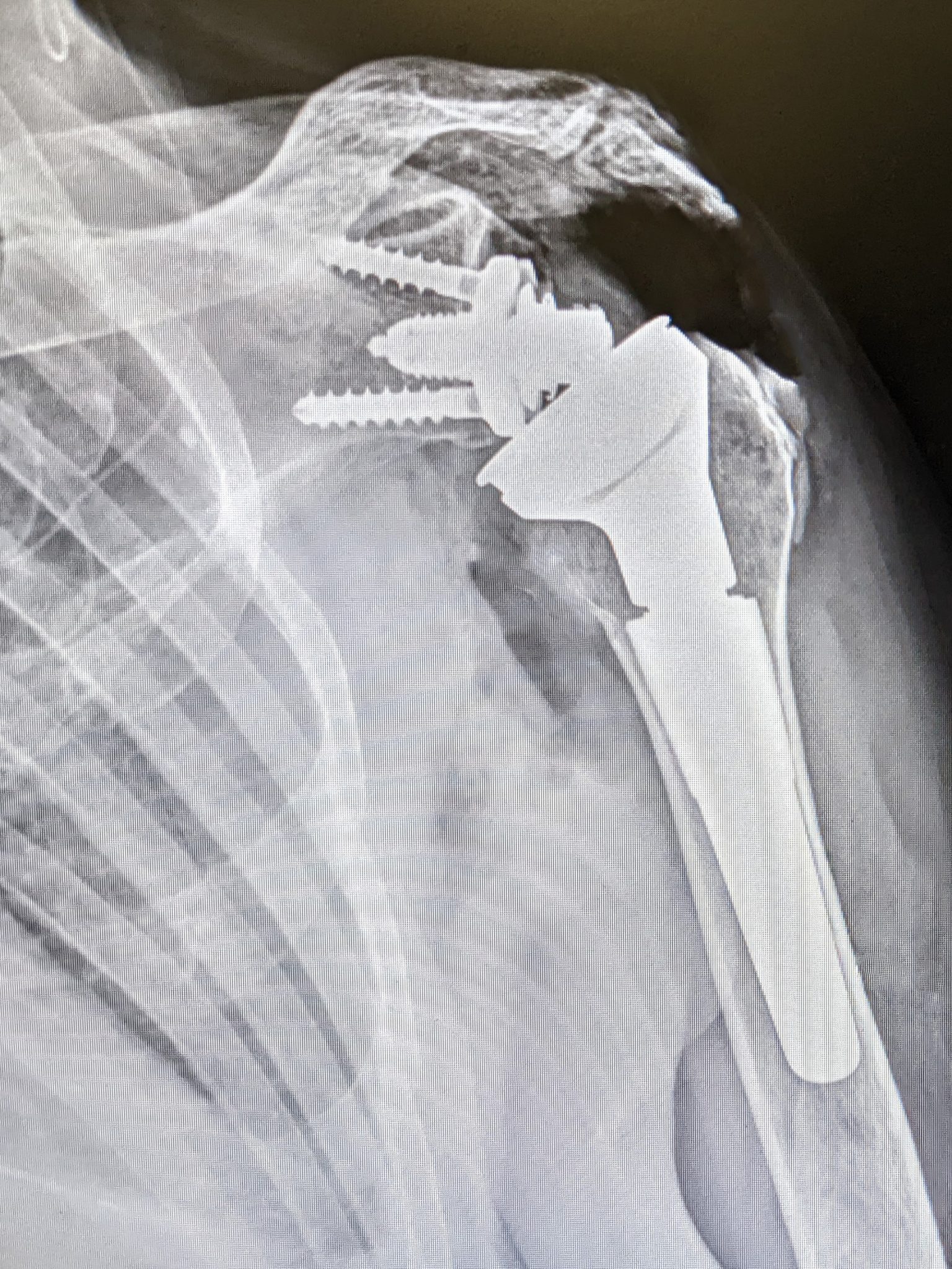 Künstliches Schultergelenk | Schulterarthrose | Schulterspezialist